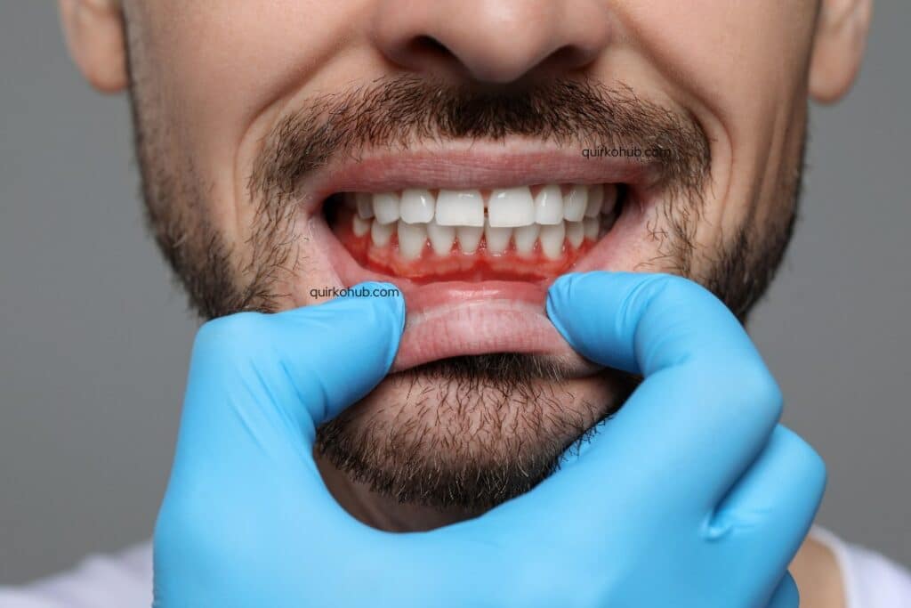 The Role of Nutrition in Preventing and Treating Purple Gums - Quirko hub