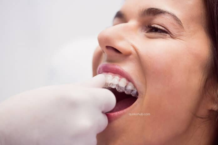Transparent Teeth Braces vs. Clear Aligners: Which is Right for You ...
